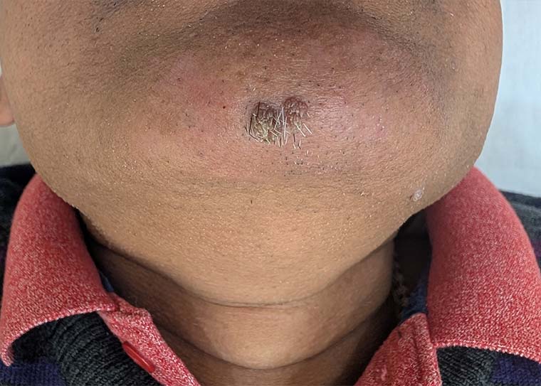 Wart, molluscum removal with cautery